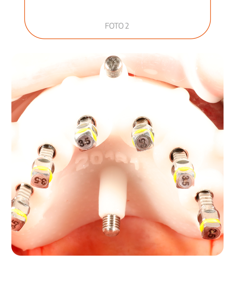CASO CLÍNICO - Com implante Hybridus® aliado à superfície Biofusion® e ao Kit Cirúrgico Guiado ...