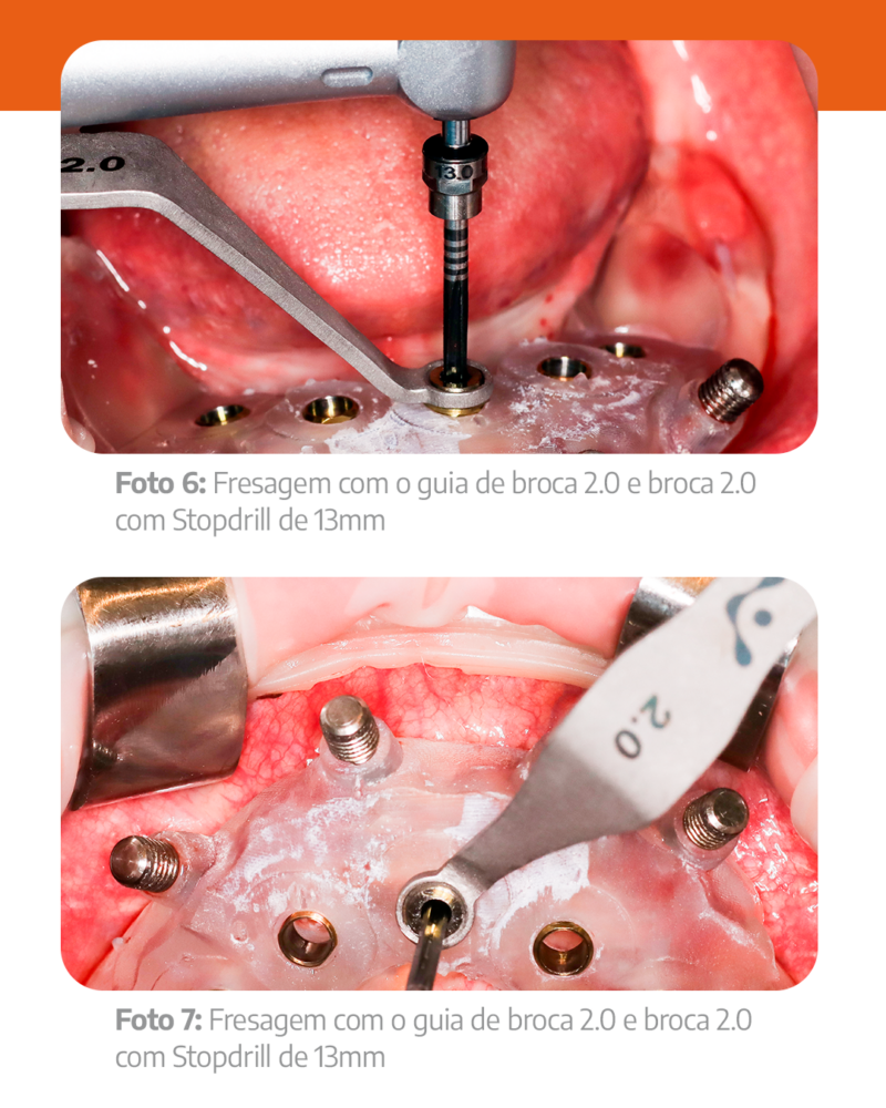 Caso Clínico: Protocolo Inferior Guiado com Implante Hybridus® - Singular Implants