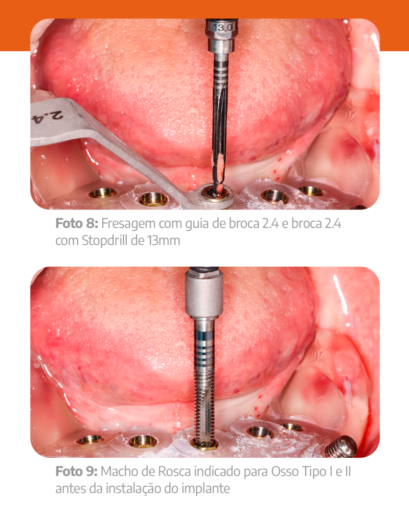 Caso Clínico: Protocolo Inferior Guiado com Implante Hybridus® - Singular Implants