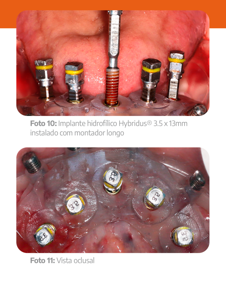 Caso Clínico: Protocolo Inferior Guiado com Implante Hybridus® - Singular Implants