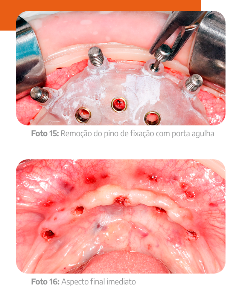 Caso Clínico: Protocolo Inferior Guiado com Implante Hybridus® - Singular Implants